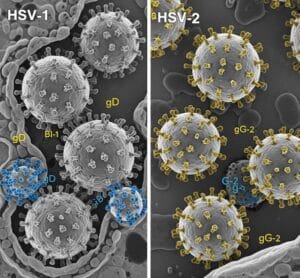 Genital Herpes HSV1 vs HSV2: Difference, Recurrence And more